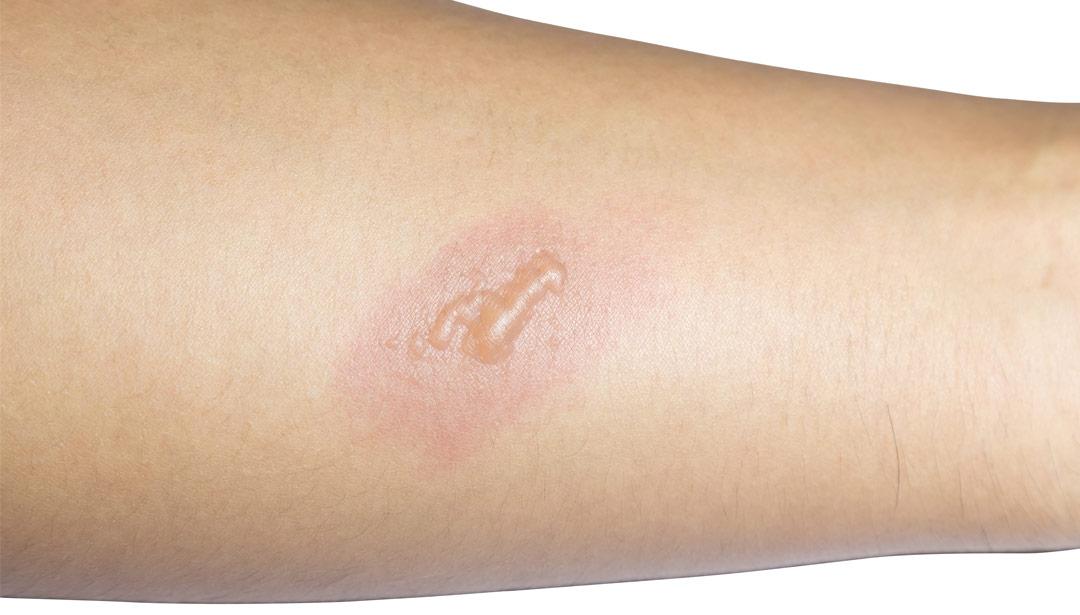 Juckender Ausschlag Tattoos Tattoo Pflege Nach Dem Stechen Und Später